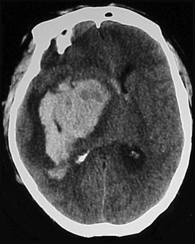 Intracranial Hemorrhage | 10 Details That You Must Know About