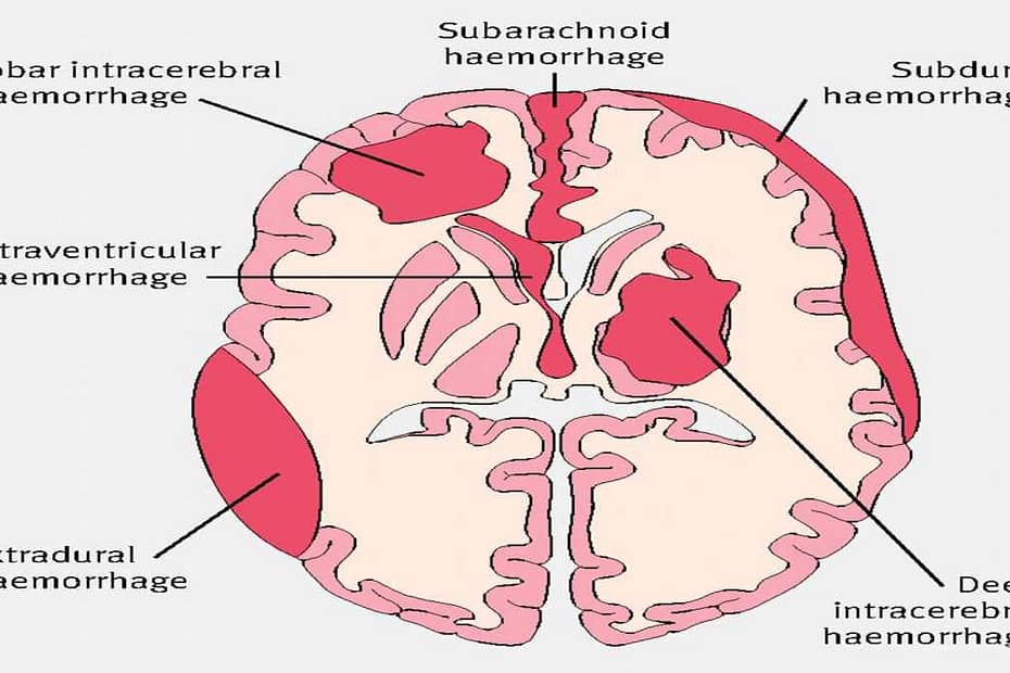 10 Details That You Must Know About Intracranial Hemorrhage Louie Gayao Md